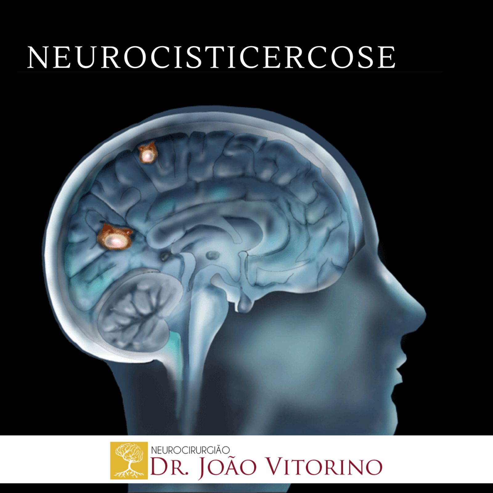 Neurocisticercose - Neurocirurgião em São Paulo - Especialista em ...