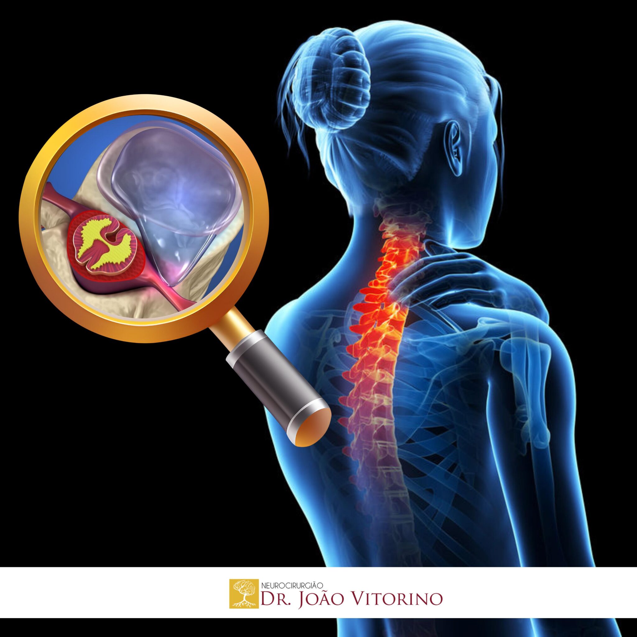 Hérnia de Disco Cervical: Quando a Cirurgia é Necessária ...